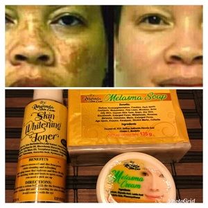 Melasma Remover | Makeup | Melasma Remover Set Soap Toner Night Cream ...